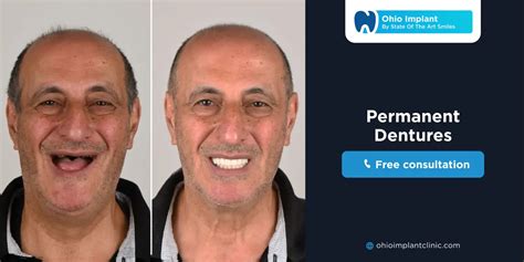 Which Types Of Permanent Dentures Offer The Best Fit And Comfort Ohio