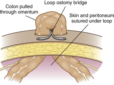 The Patient With An Ostomy
