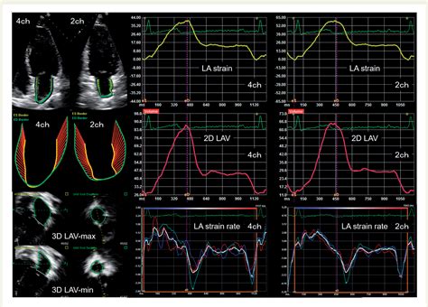 Figure 1 From Echocardiographic Reference Ranges For Normal Left Atrial