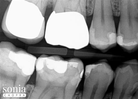 Why You Must Perform A Cold Test On Teeth Tooth Story