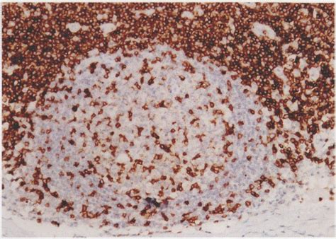 如何正确识别与评价免疫组化结果 淋巴瘤病理诊断