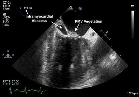 Intramyocardial Abscess Still Left Ventricular Long Axis View At 110