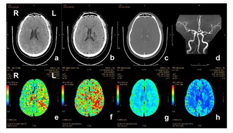 Ct And Ctp Imaging Of The Patient With Acute Ischemic Stroke The Download Scientific Diagram