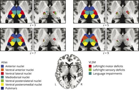 Involvement Of Thalamocortical Networks In Patients With Poststroke