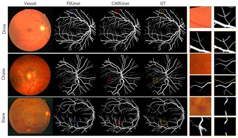 Retinal Vessel Segmentation Based On Self Attention Feature Selection