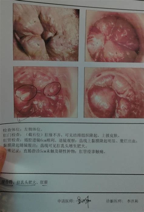 大便太细拉不出来是它导致的吗需要手术吗还是说是大便问题导致混合肛裂 肛肠外科讨论版 爱爱医医学论坛