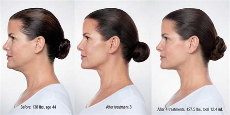 Kybella Lexington Ma Face Forward Medical Aesthetics