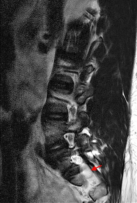 Dural Ectasia Radsource
