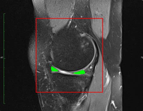 Watershed Segmentation Method Results In A Case Of Larger Roi