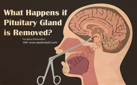 What Happens If Pituitary Gland Is Removed
