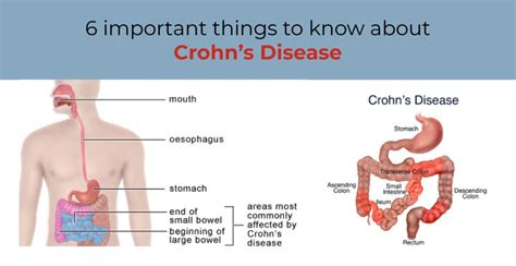 Crohns Disease Symptoms Causes Complications Prevention 50 Off