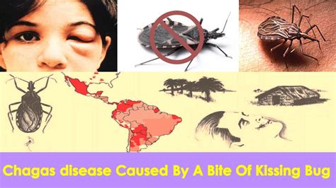 Chagas Disease Caused By A Bite Of Kissing Bug Youtube