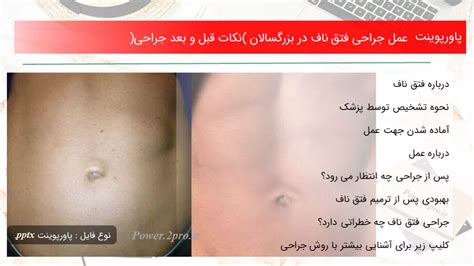 عمل جراحی فتق ناف در بزرگسالان نکات قبل و بعد جراحی