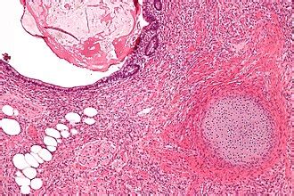 Teratoma Wikipedia La Enciclopedia Libre