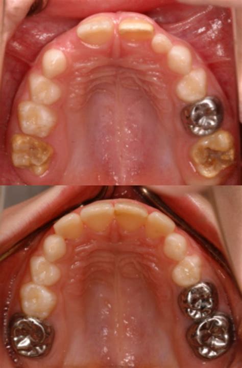 Tooth Enamel Defects Clayton 3 Fixes Clarinda Clinic