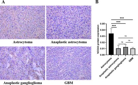Clinical Significance Of Ncoa4 In Glioblastoma Diagnostic Prognostic