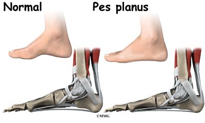 Flat Feet