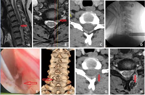 A Patient With Csr C6 7 Left Foraminal Bony Stenosis Female 52 Download Scientific Diagram