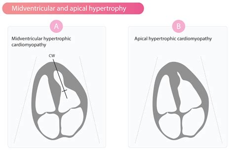 Hypertrophic Cardiomyopathy Hcm And Hypertrophic Obstructive Cardiomyopathy Hocm The