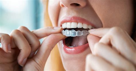 Teeth Aligners Do They Work El Camino Health