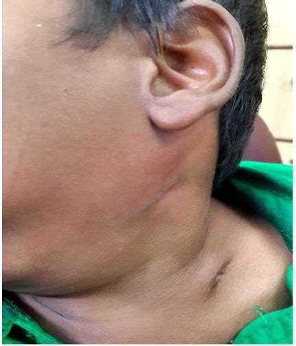 Discharging Sinuses Over Cervical Lymph Nodes Download Scientific