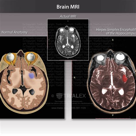 Colorized Brain Mri With Herpes Simplex Encephalitis Trialexhibits Inc