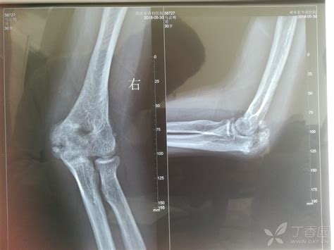 异位骨化骨化骨化症第8页大山谷图库