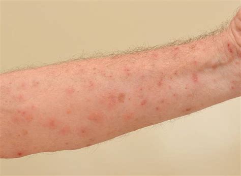 Pimples On Arm Or Keratosis Pilaris Bumps How Do You Treat Them