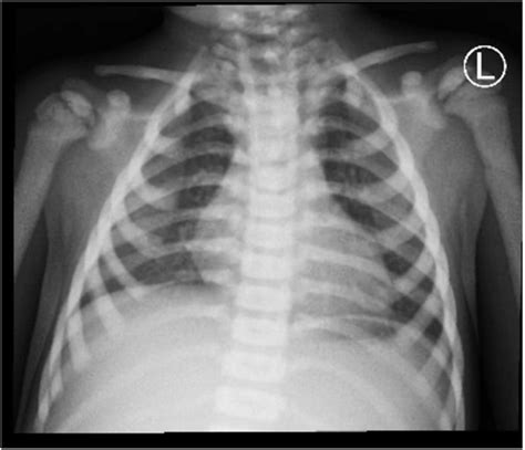 Chest X Ray Shows Generalized Increase In Bone Density Download