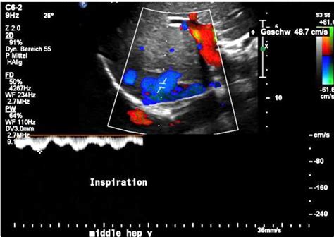 Transverse Liver Ultrasound Diaphragm