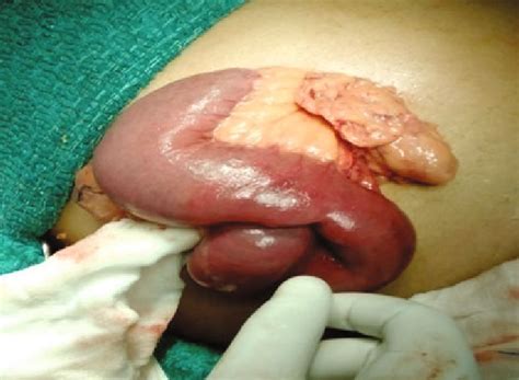 Port Site Hernia Herniated Bowel Loop With Omentum Download