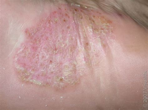 Rheumatoid Arthritis Rash Treatment