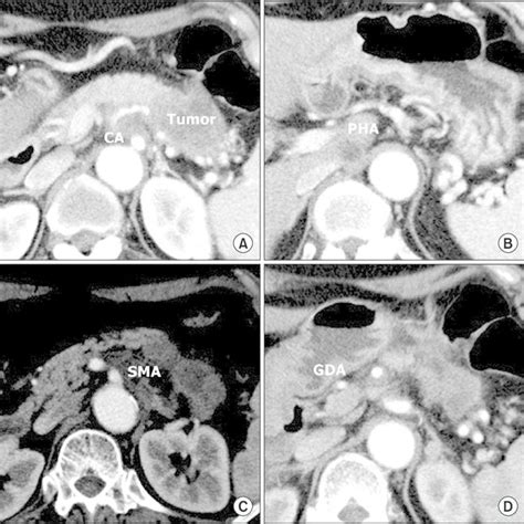 Pdf Distal Pancreatectomy With Celiac Axis Resection For Pancreatic Body And Tail Cancer
