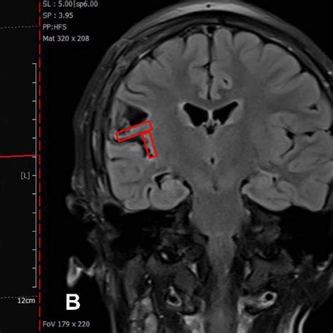 Stereotactic Radiosurgery Plan For The Right Operculo Insular Area In
