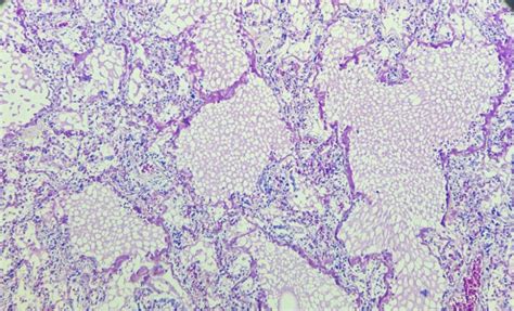 Diffuse Alveolar Damage With Hyaline Membranes He X10 Download