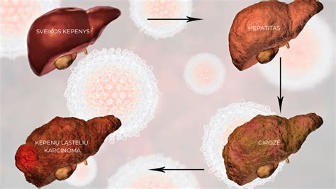 Kepenų Cirozė Priežastys Simptomai Gydymas Ir Prevencija Biofirst