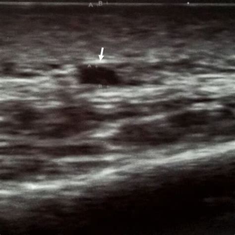 Cross Sectional Doppler Ultrasound View Of Right Temporal Artery Arrow Download Scientific