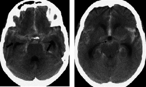 Computed Tomography Scan Of Patient With Subarachnoid Hemorrhage
