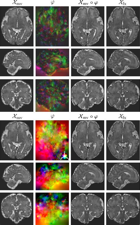 Figure 1 From Unsupervised Segmentation Of Fetal Brain Mri Using Deep