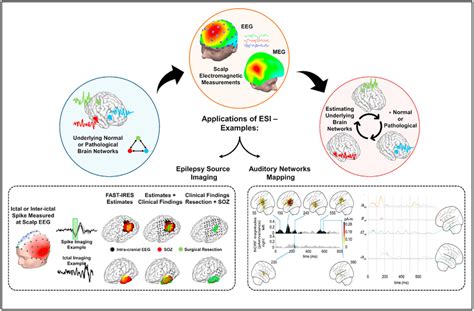 Examples Of Extent Imaging And Its Application In Epilepsy Network Download Scientific Diagram