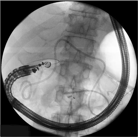 Retrograde Endosonography For Diagnosing Imaging Occult Cancer At The Head Of The Pancreas In A