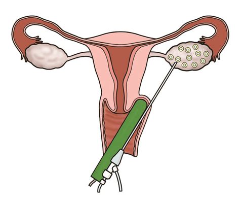 Fertility Preservation Information For Girls And Young Women Leeds