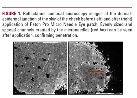 In Vivo Reflectance Confocal Microscopy Evaluation Of Microneedle Patch Penetration Depth