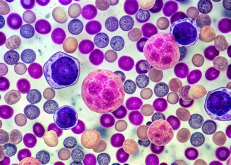 Deep Responses In Smoldering Multiple Myeloma Linked To Improved Outcomes