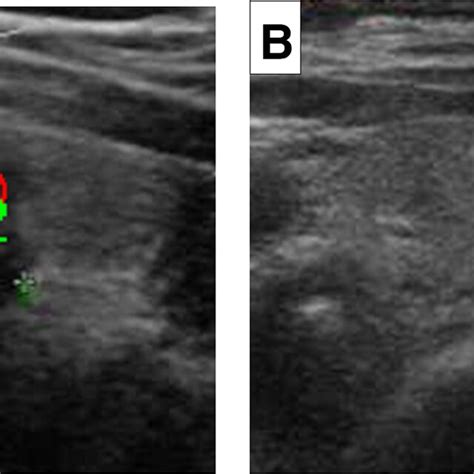 For Ptcs With Homogeneous Echogenicity A Regions Of Interest Rois