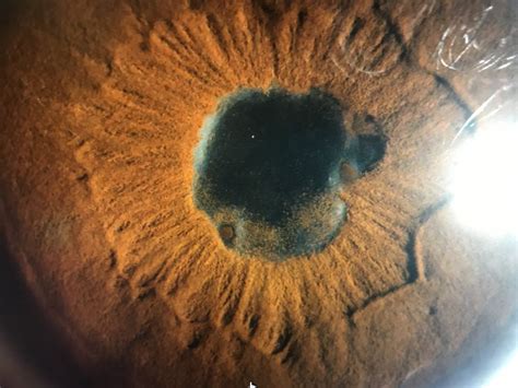 Posterior Uveitis Uveitis Induced Posterior Synechiae Digital