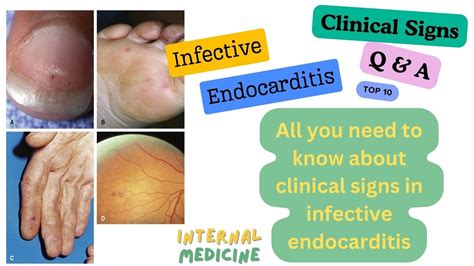 Infective Endocarditis Signs