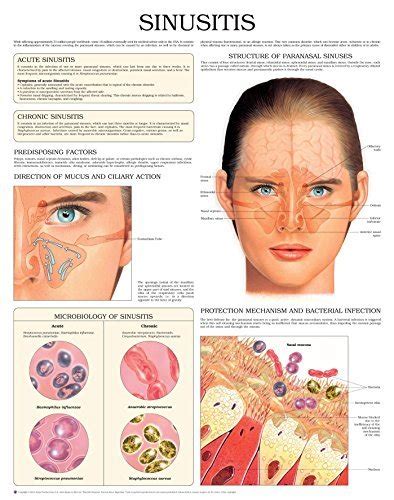 Sinusitis E Chart Full Illustrated By Hc Healthcomm Goodreads