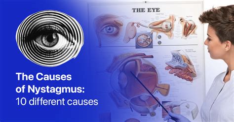The Connection Between Cerebellar Lesions And Nystagmus