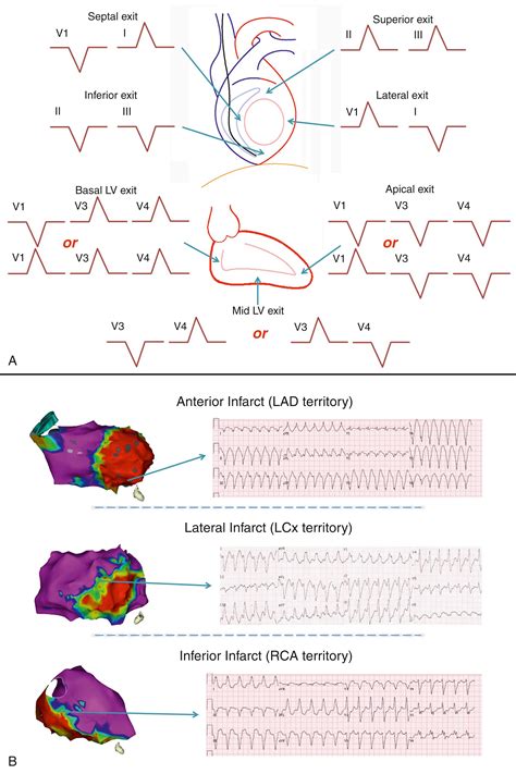 Ablation Of Postmyocardial Infarction Ventricular Tachycardia